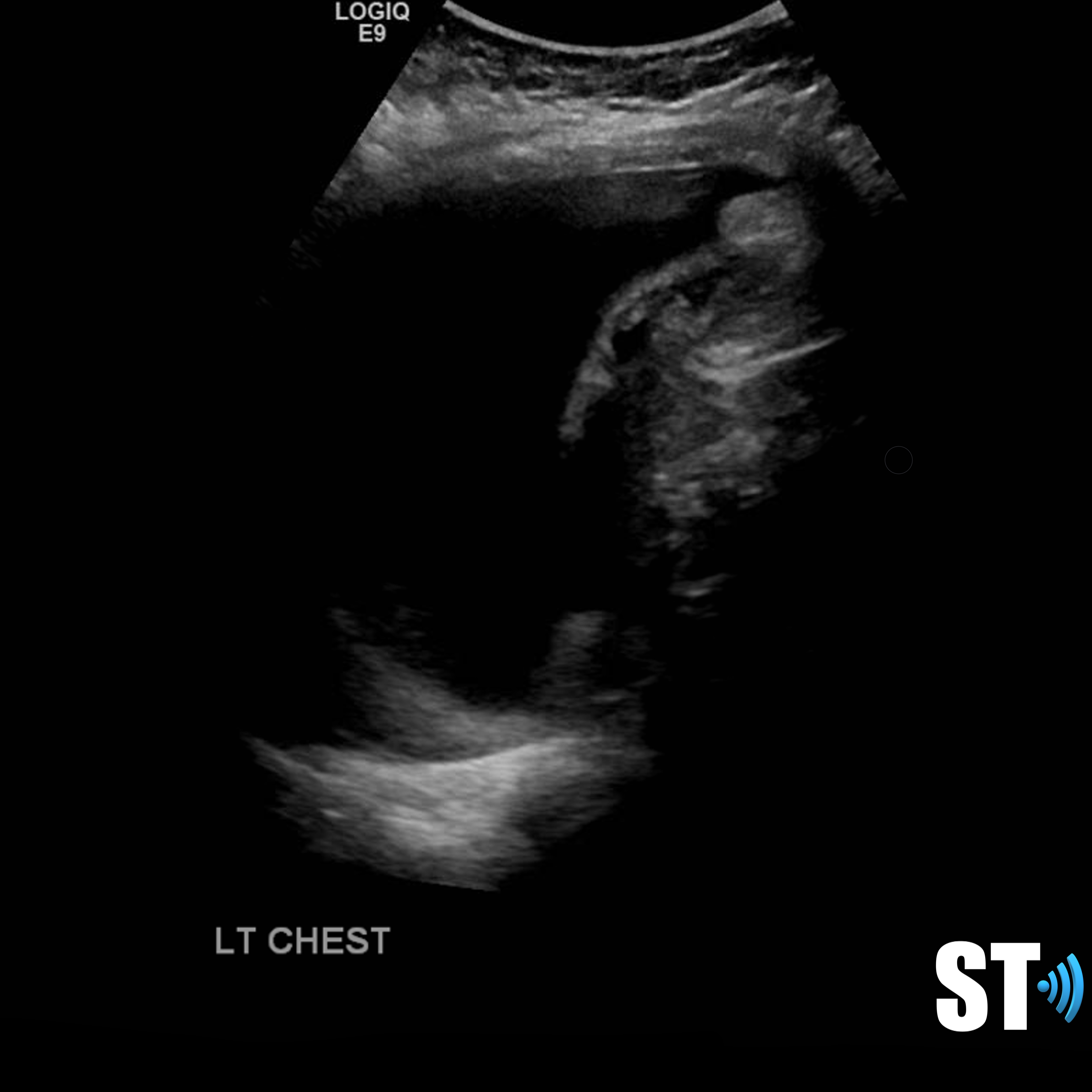 Chest and Lung Ultrasound – Sonographic Tendencies