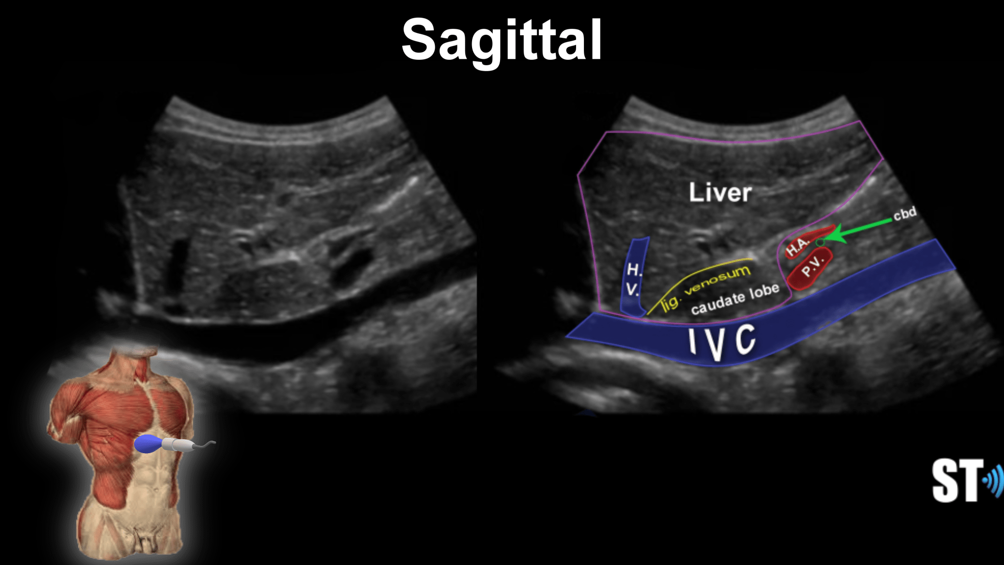Liver Anatomy and Protocol – Sonographic Tendencies