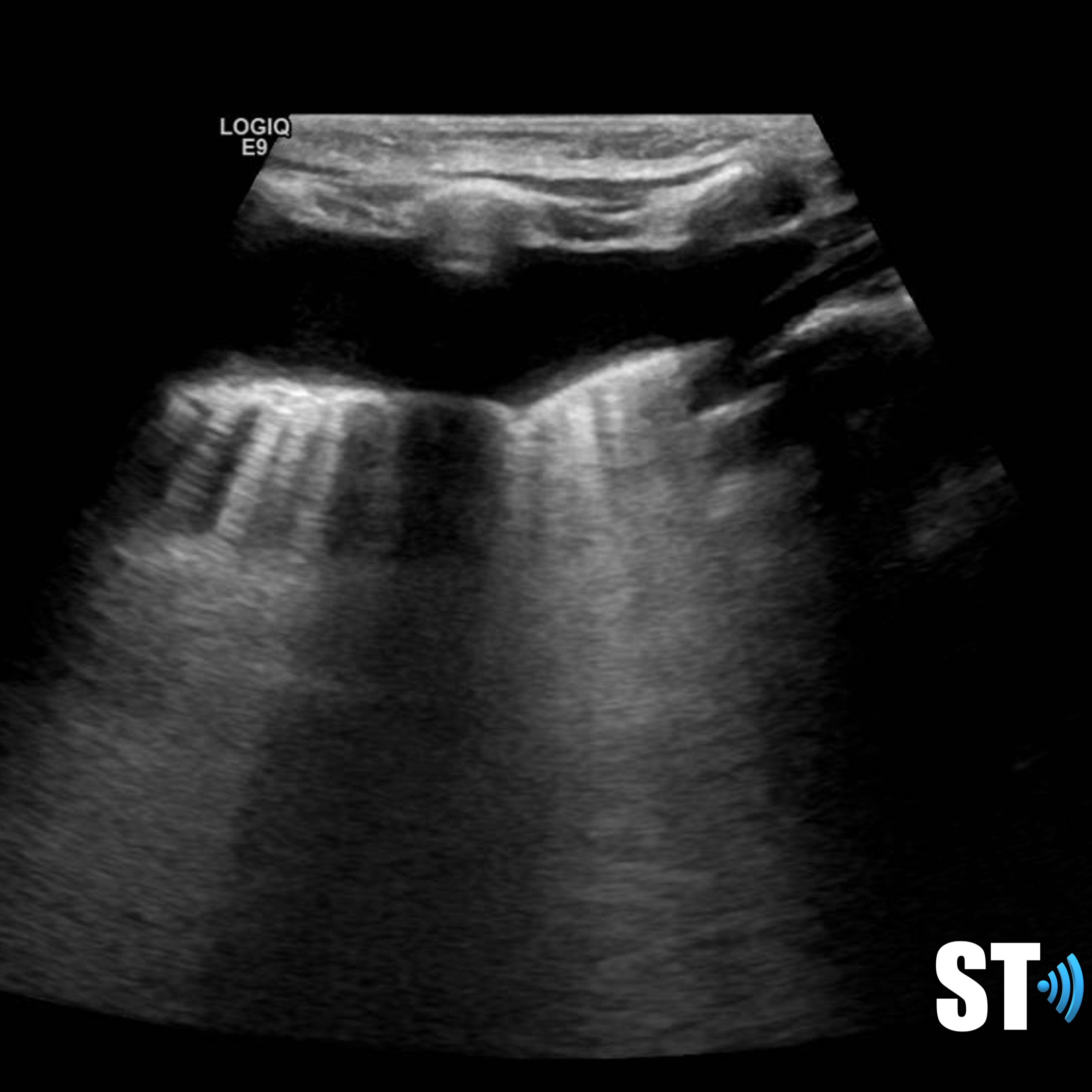 Chest and Lung Ultrasound – Sonographic Tendencies