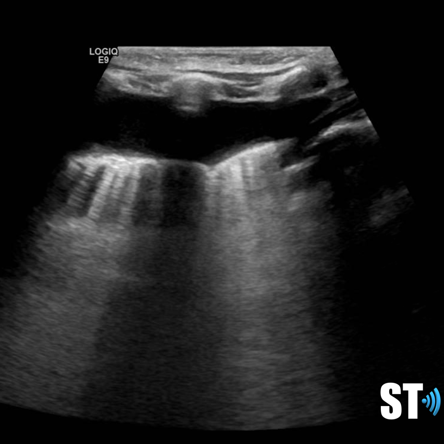 Chest and Lung Ultrasound – Sonographic Tendencies