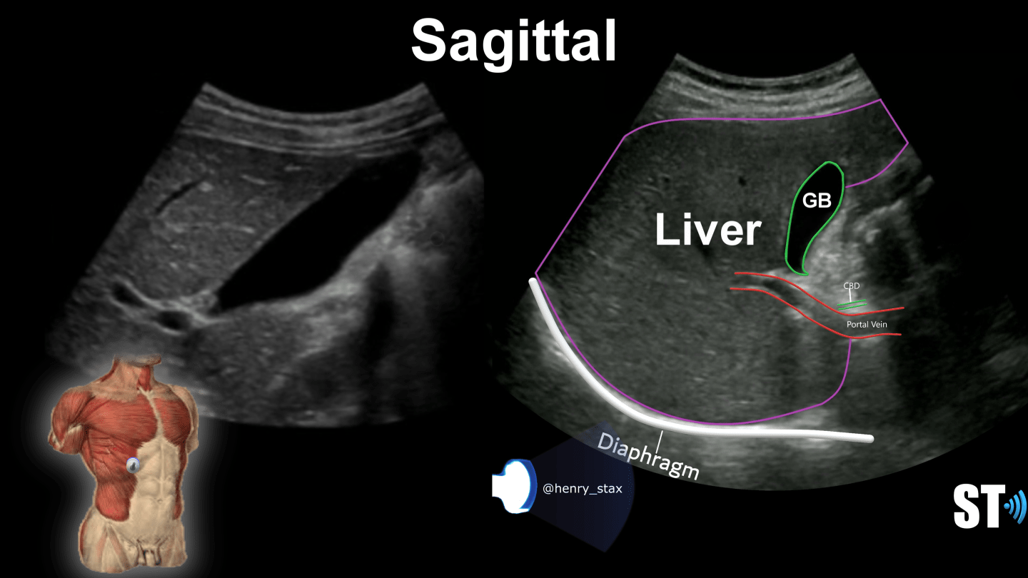 Liver Anatomy and Protocol – Sonographic Tendencies