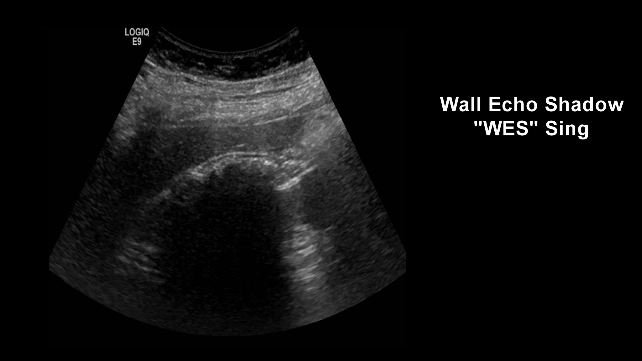 Gallbladder and Biliary Pathology – Sonographic Tendencies