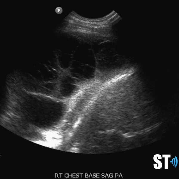Chest and Lung Ultrasound – Sonographic Tendencies