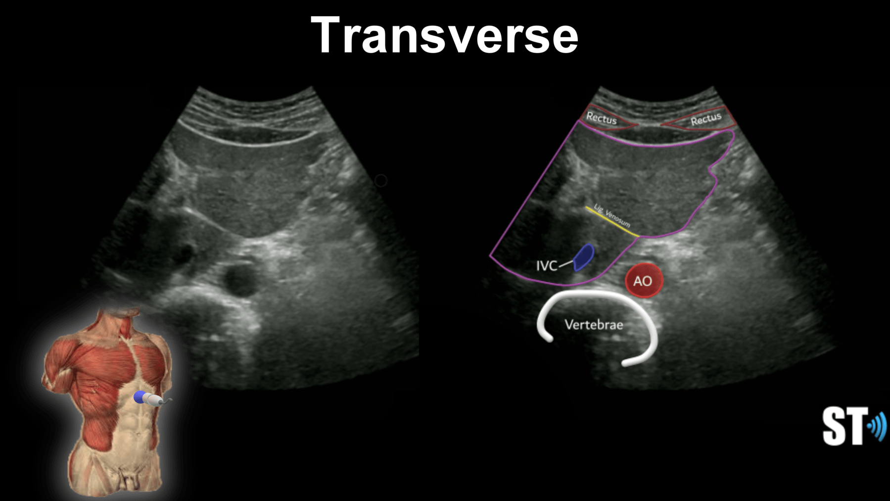 Liver Anatomy and Protocol – Sonographic Tendencies