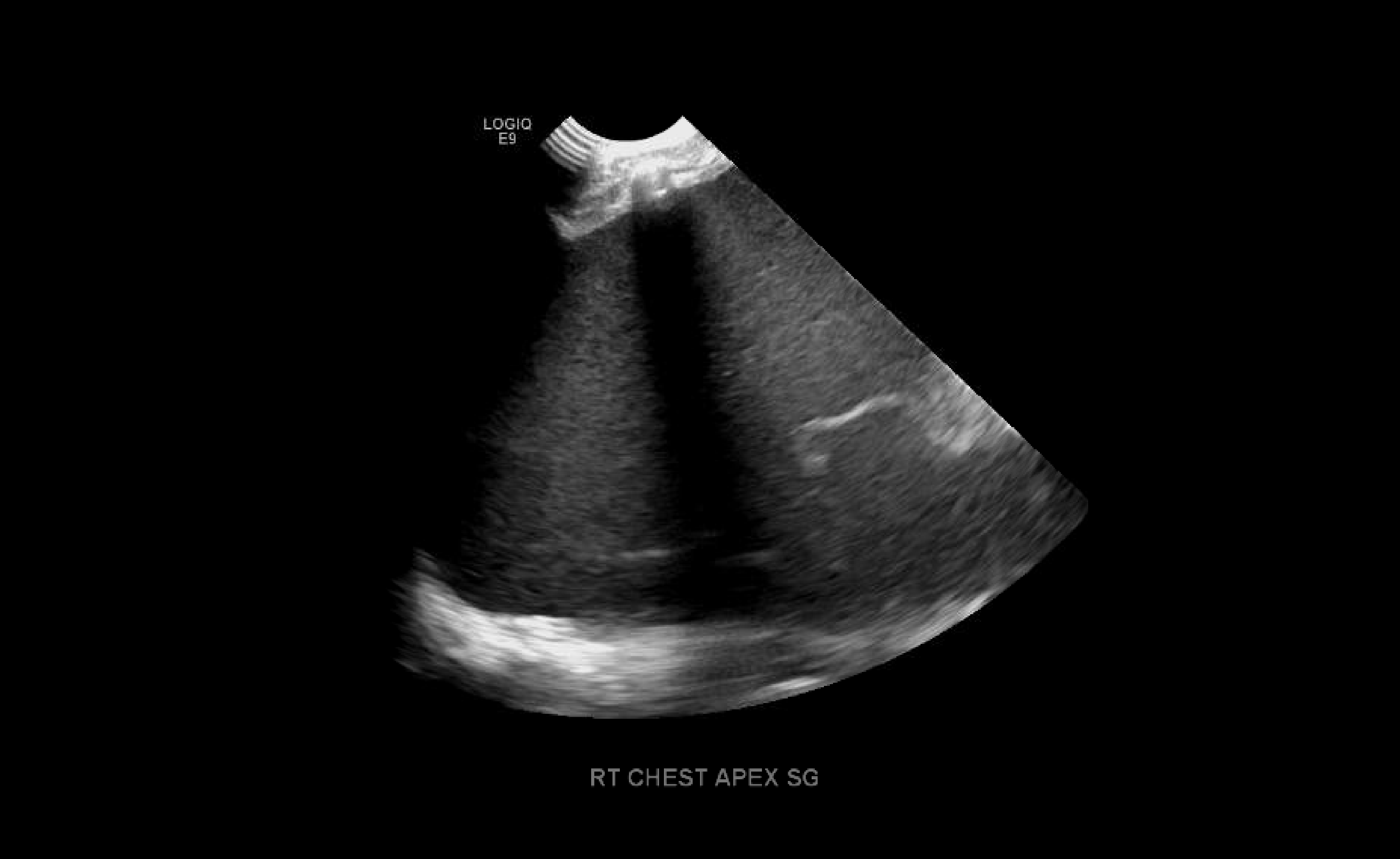 Chest and Lung Ultrasound – Sonographic Tendencies