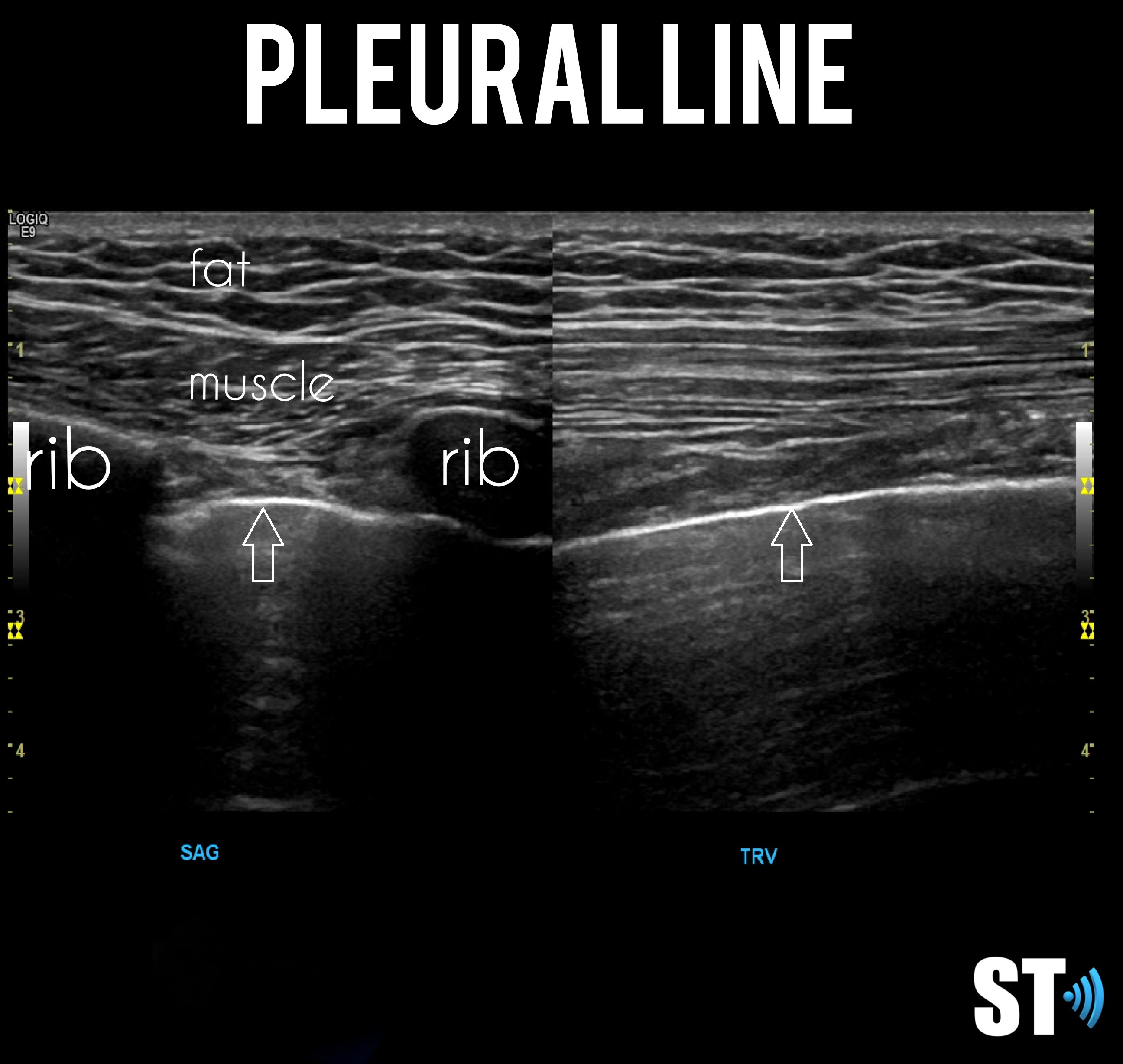 Chest and Lung Ultrasound – Sonographic Tendencies