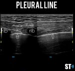 Chest and Lung Ultrasound – Sonographic Tendencies