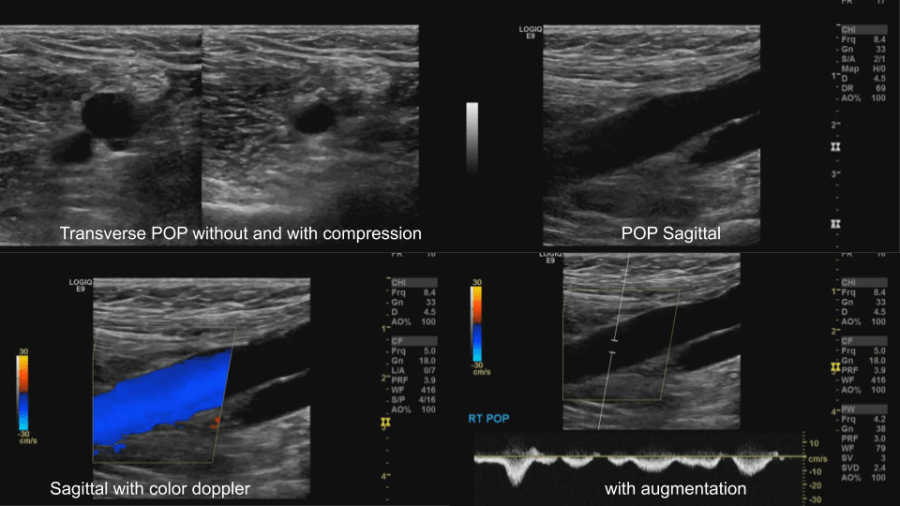 Lower Extremity Venous Duplex Protocol – Sonographic Tendencies