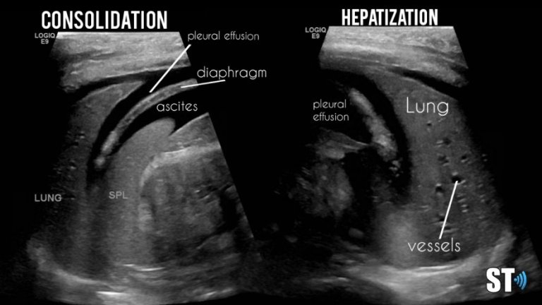 Chest and Lung Ultrasound – Sonographic Tendencies