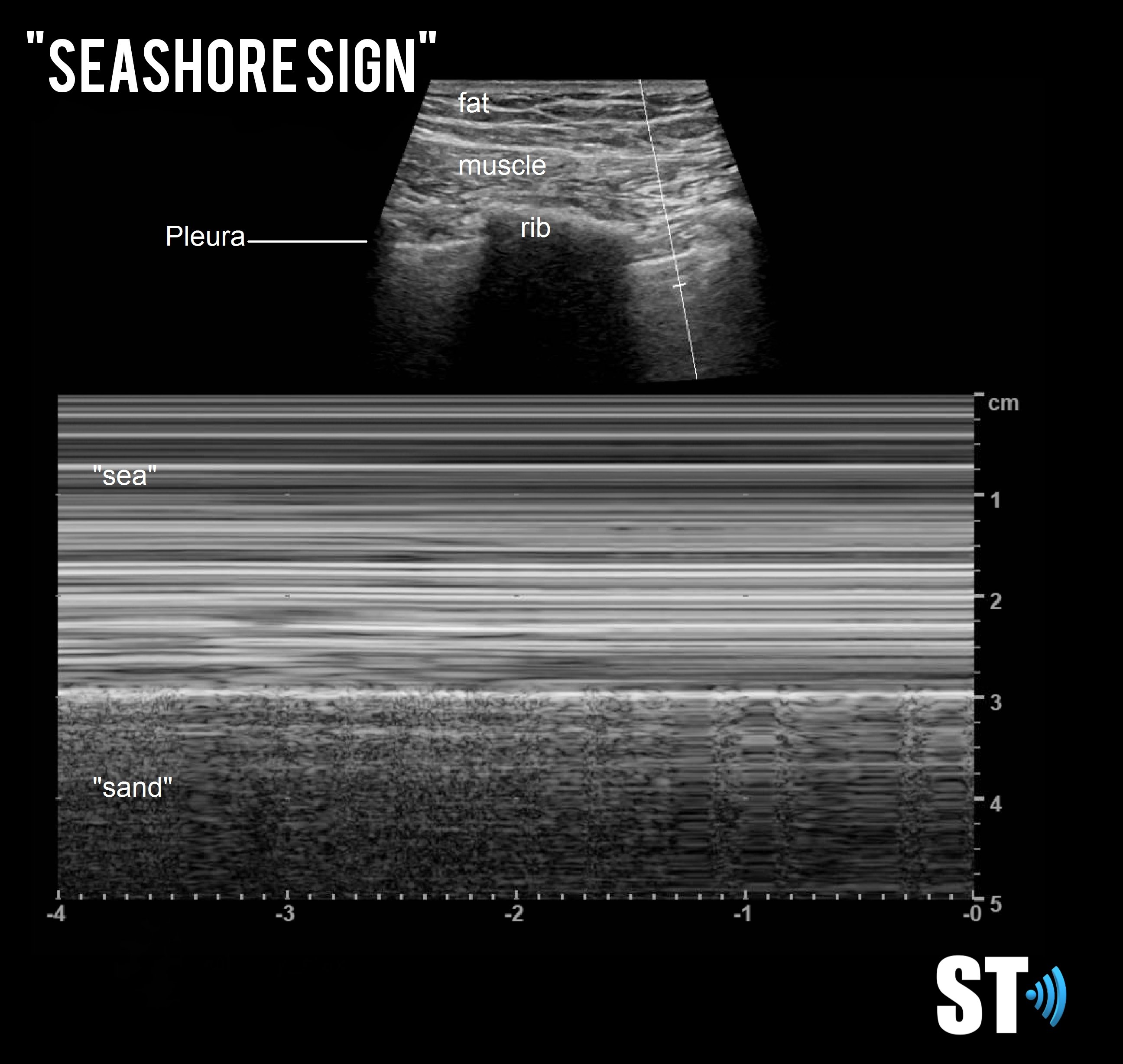 Chest and Lung Ultrasound – Sonographic Tendencies