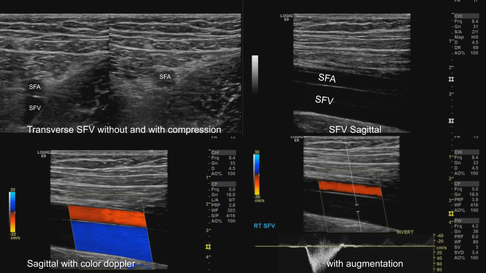 Lower Extremity Venous Duplex Protocol – Sonographic Tendencies