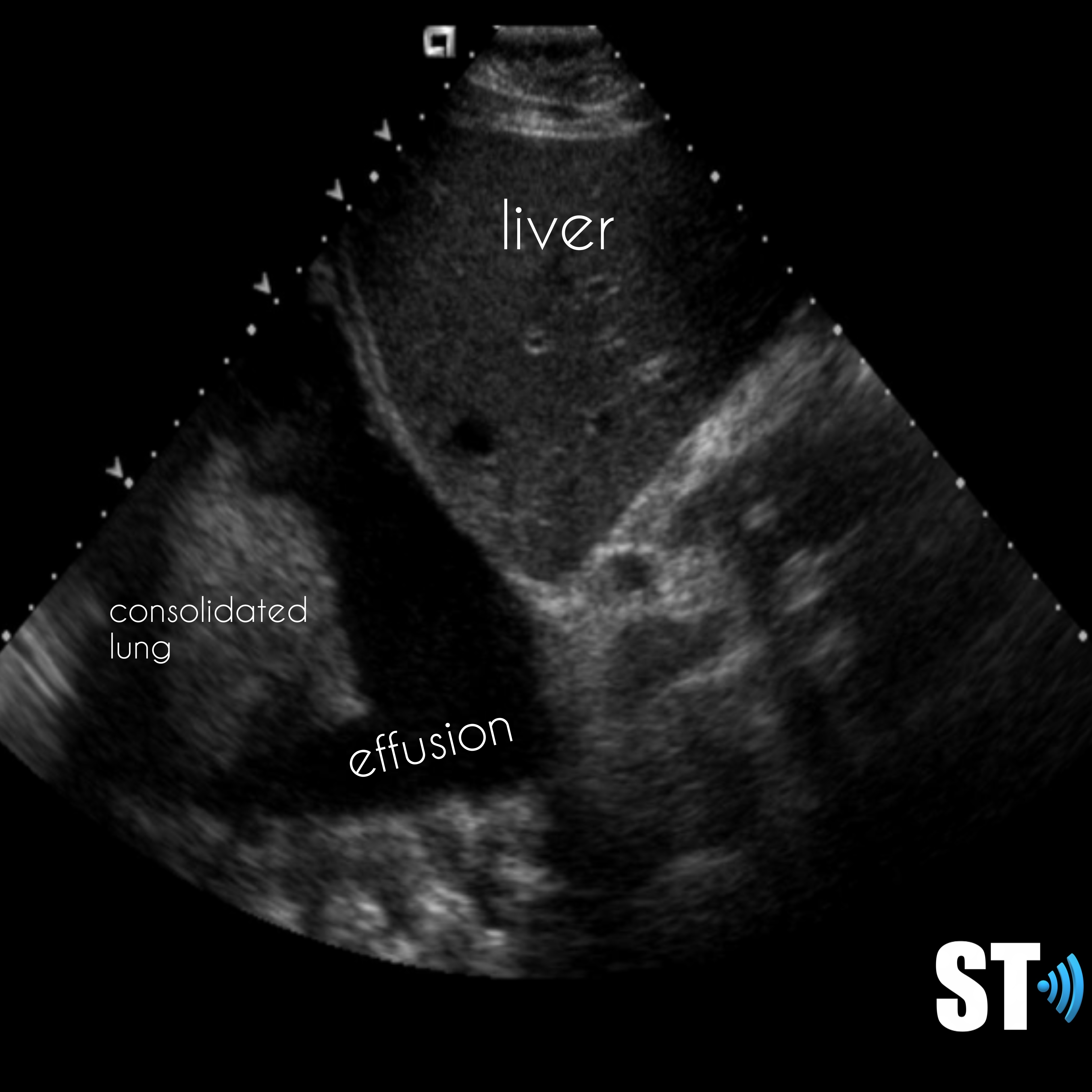 Chest and Lung Ultrasound – Sonographic Tendencies