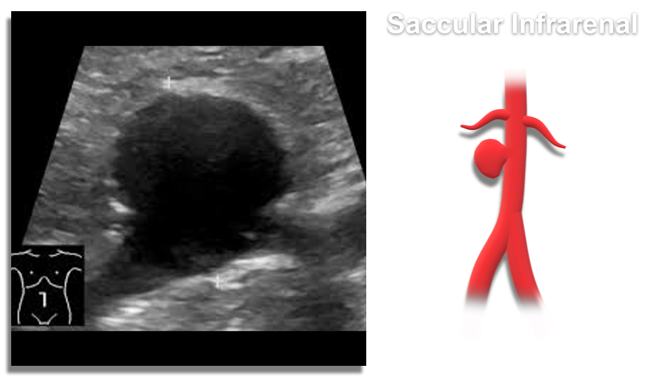 Abdominal Aortic Aneurysm – Sonographic Tendencies