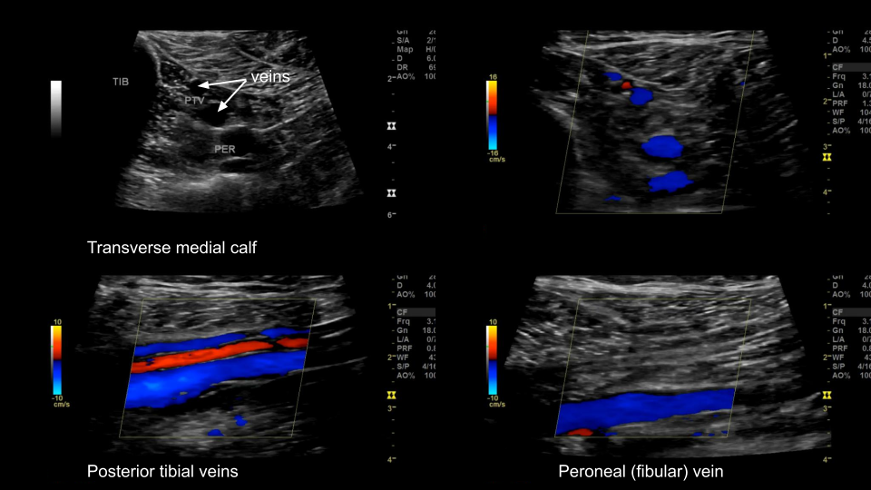 Lower Extremity Venous Duplex Protocol – Sonographic Tendencies
