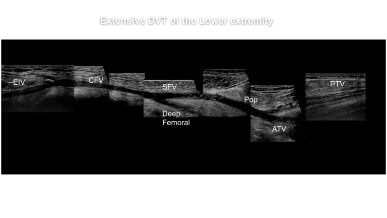 Lower Extremity Venous Duplex Protocol – Sonographic Tendencies