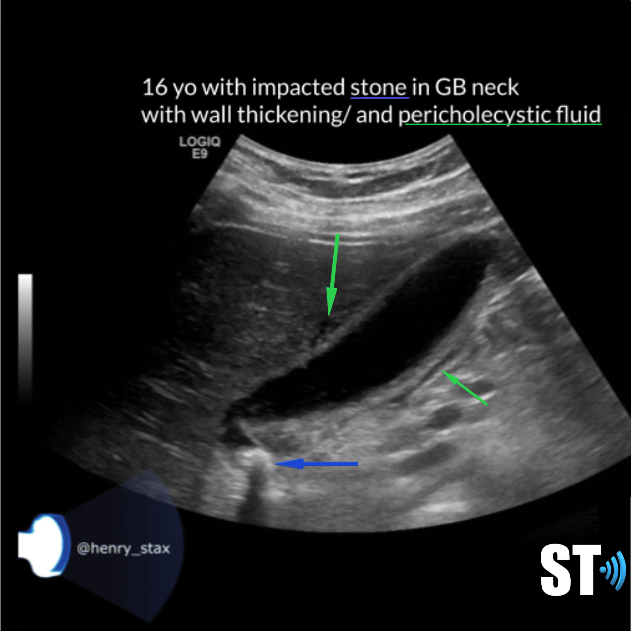 Gallbladder and Biliary Pathology – Sonographic Tendencies