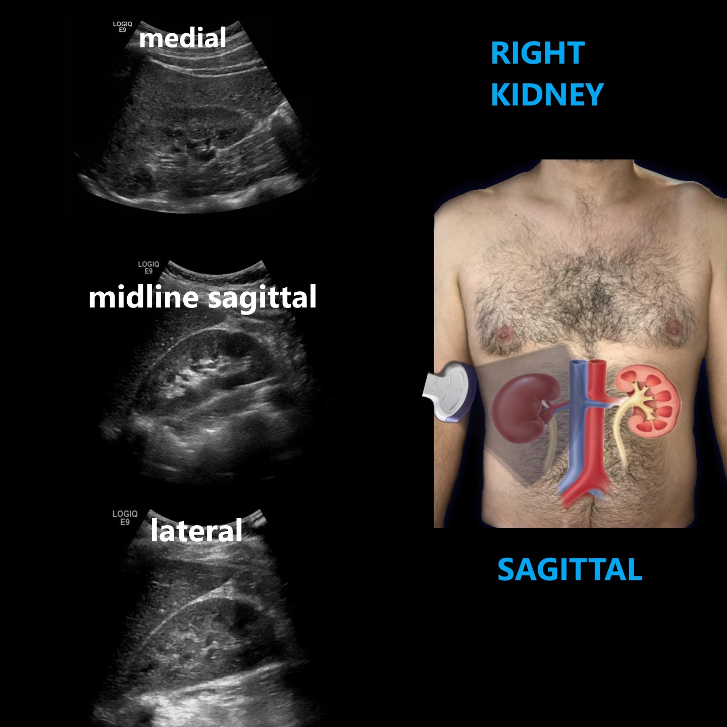 Renal Ultrasound Complete Protocol – Sonographic Tendencies