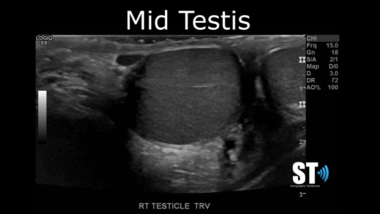 Testicular/Scrotal Doppler Protocol – Sonographic Tendencies