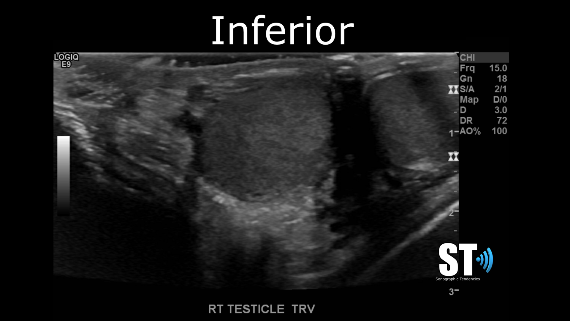 Testicular/Scrotal Doppler Protocol – Sonographic Tendencies
