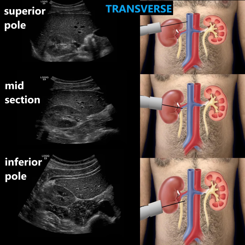 Renal Ultrasound Complete Protocol – Sonographic Tendencies