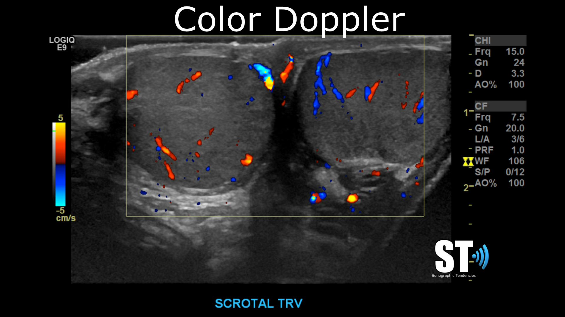 Testicular/Scrotal Doppler Protocol – Sonographic Tendencies