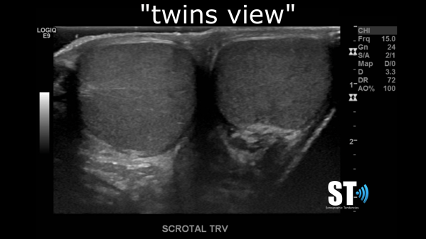 Testicular/Scrotal Doppler Protocol – Sonographic Tendencies