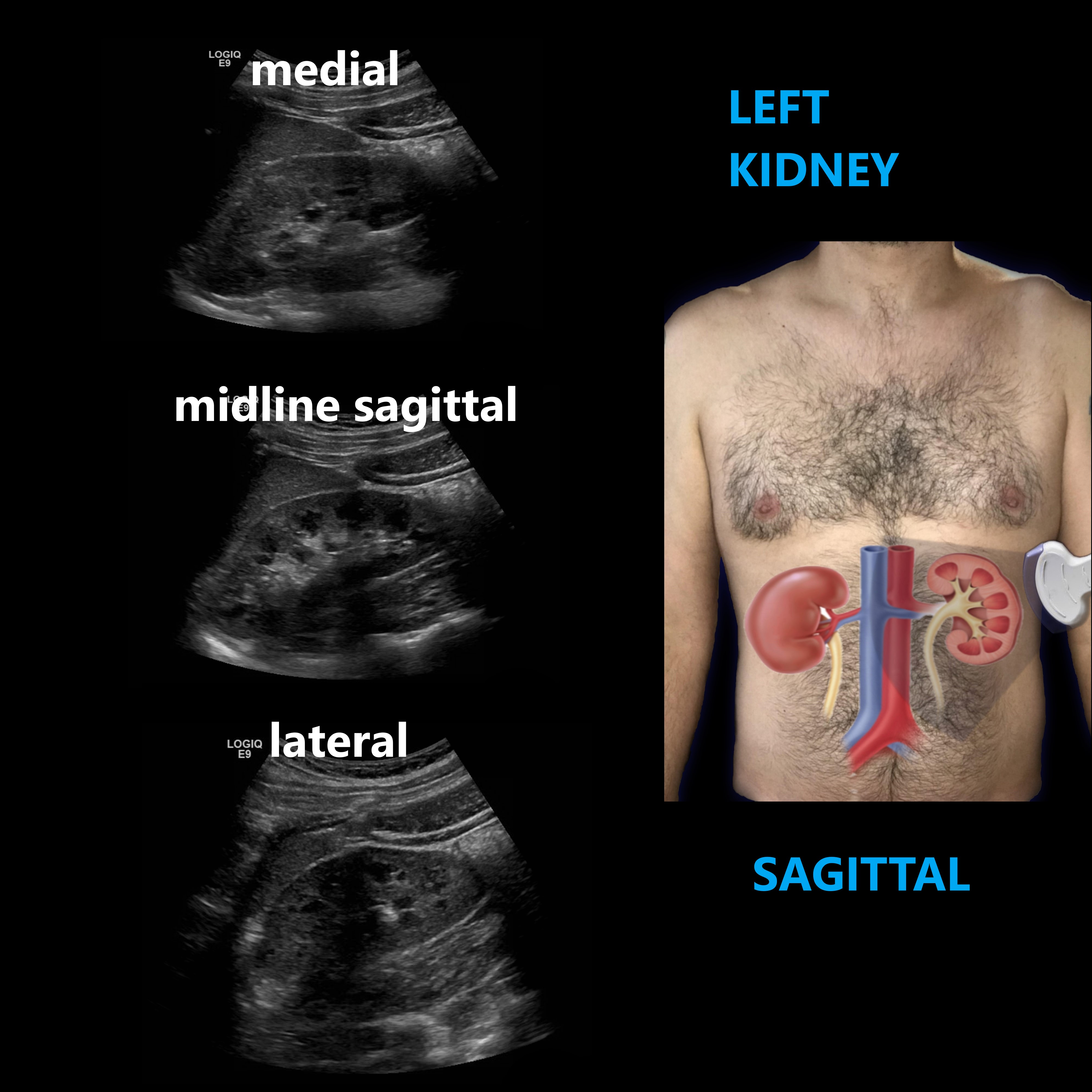 Renal Ultrasound Complete Protocol – Sonographic Tendencies