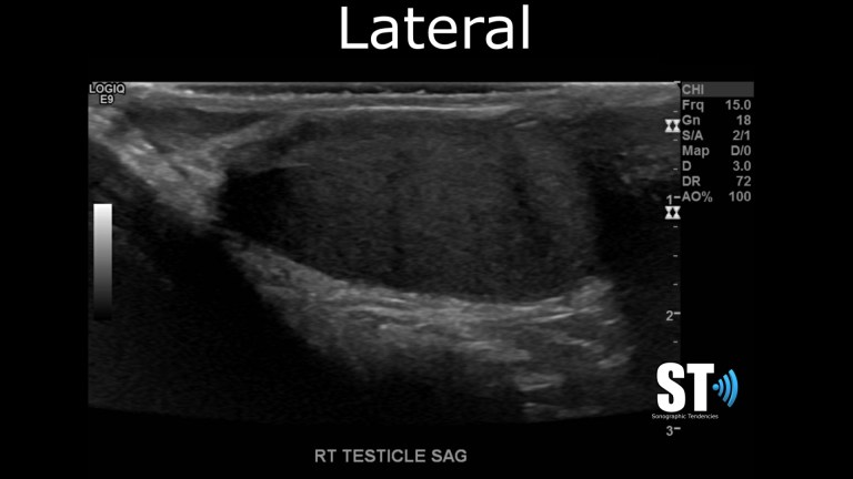 Testicular/Scrotal Doppler Protocol – Sonographic Tendencies