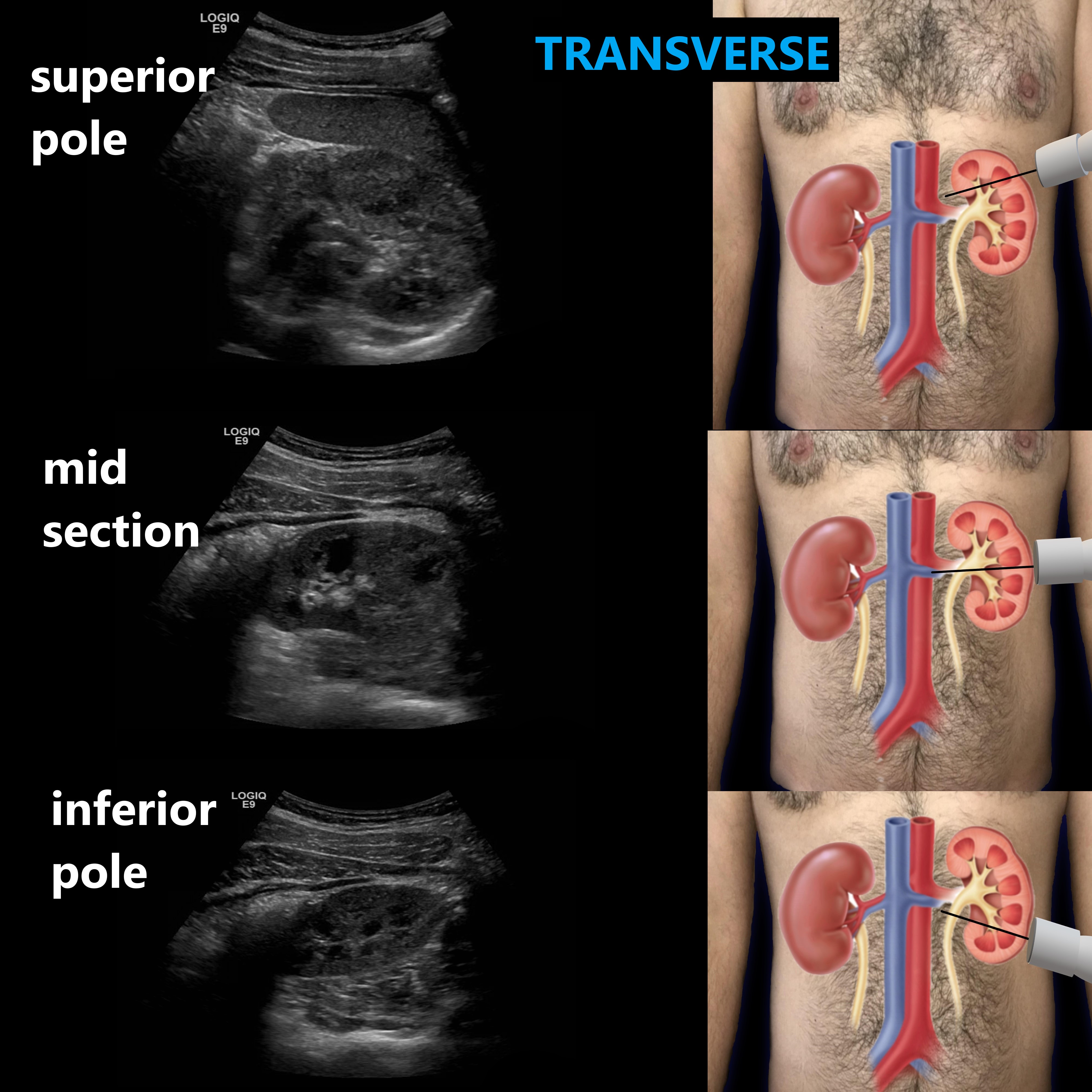 Renal Ultrasound Complete Protocol – Sonographic Tendencies