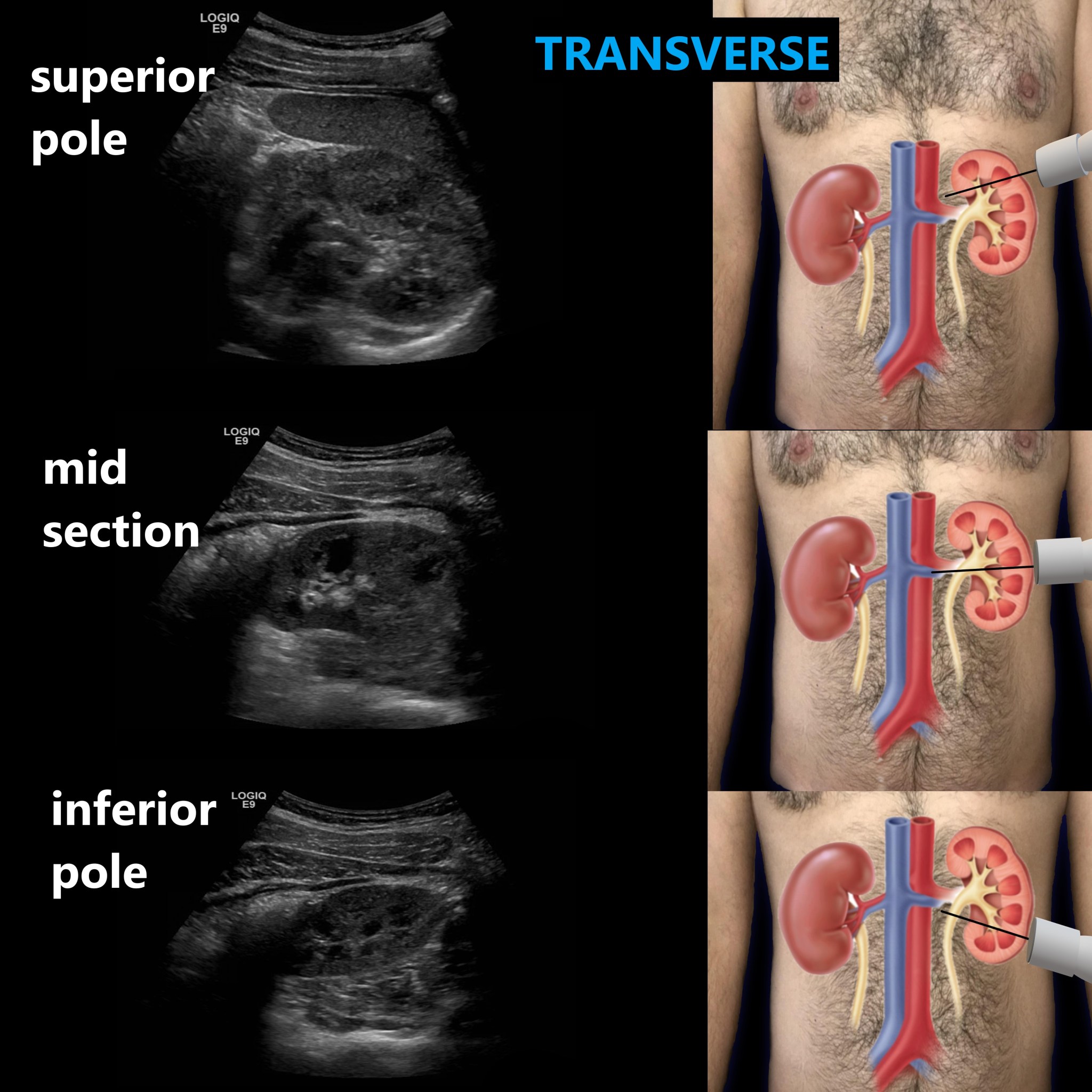 Renal Ultrasound Complete Protocol – Sonographic Tendencies