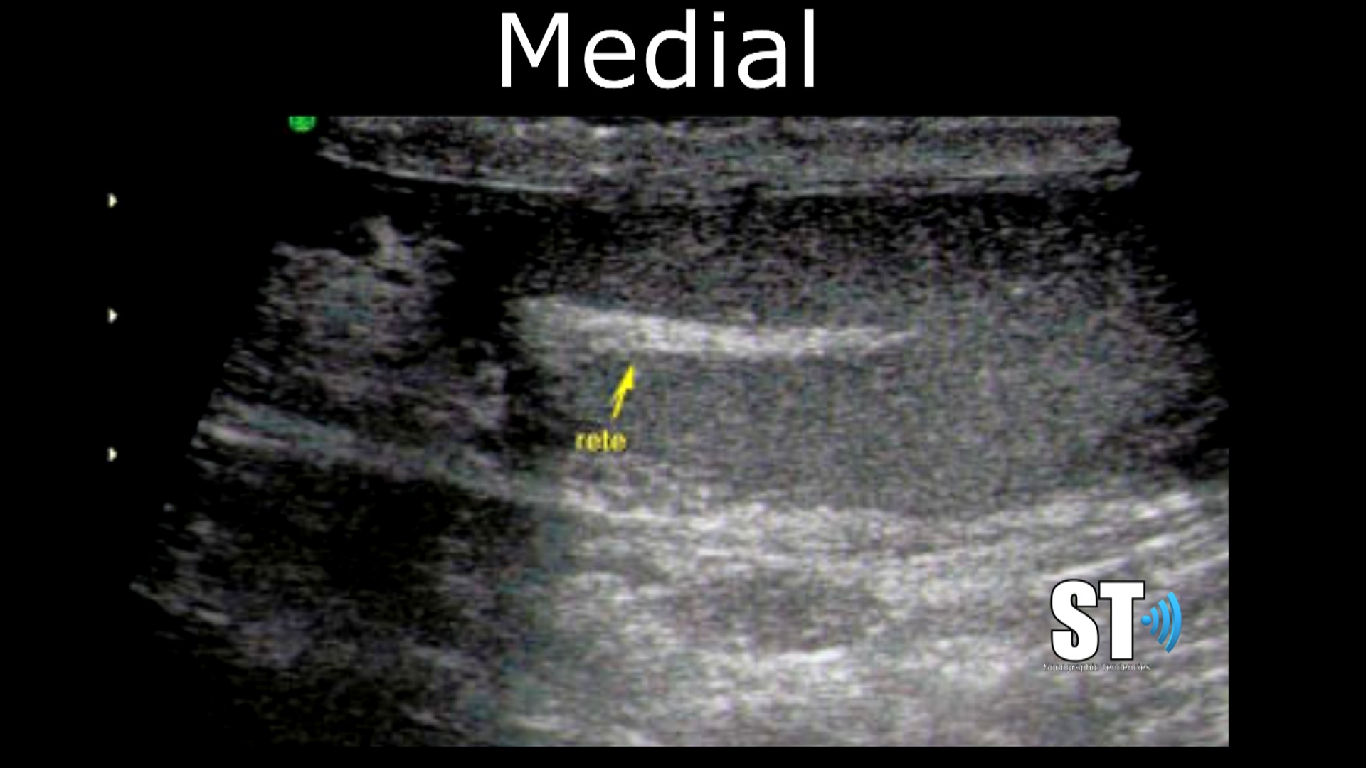 Testicular/Scrotal Doppler Protocol – Sonographic Tendencies