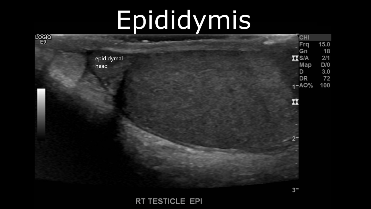 Testicular/Scrotal Doppler Protocol – Sonographic Tendencies
