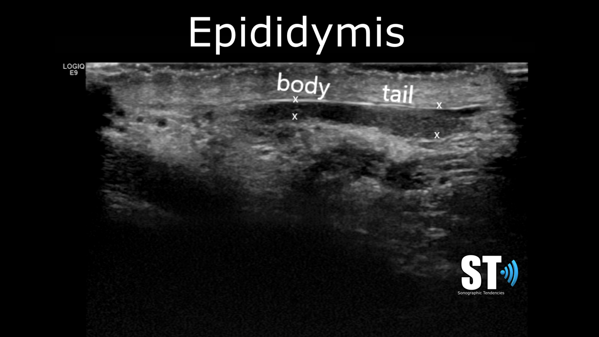 Testicular/Scrotal Doppler Protocol – Sonographic Tendencies
