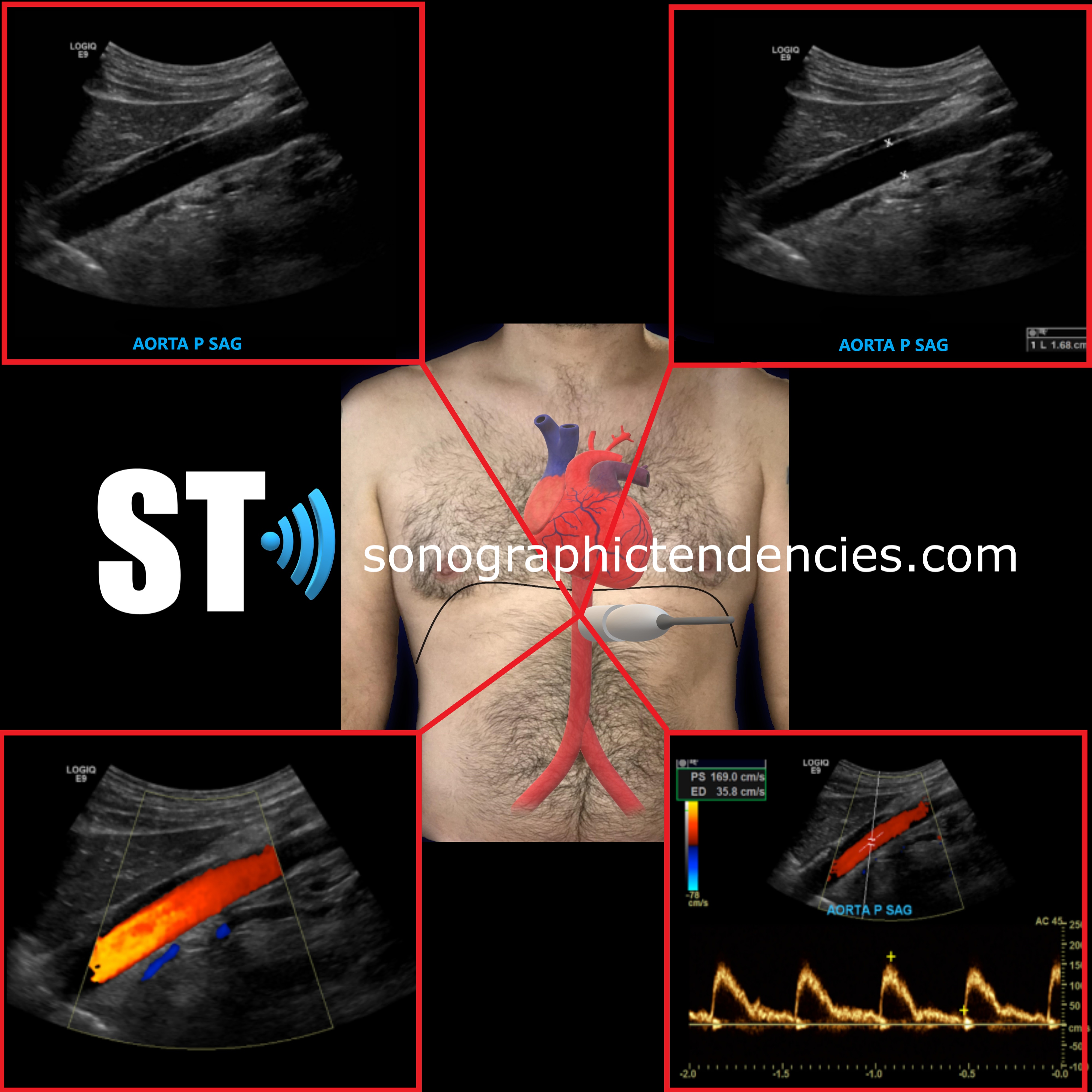 Aorta Duplex/Doppler Protocol – Sonographic Tendencies