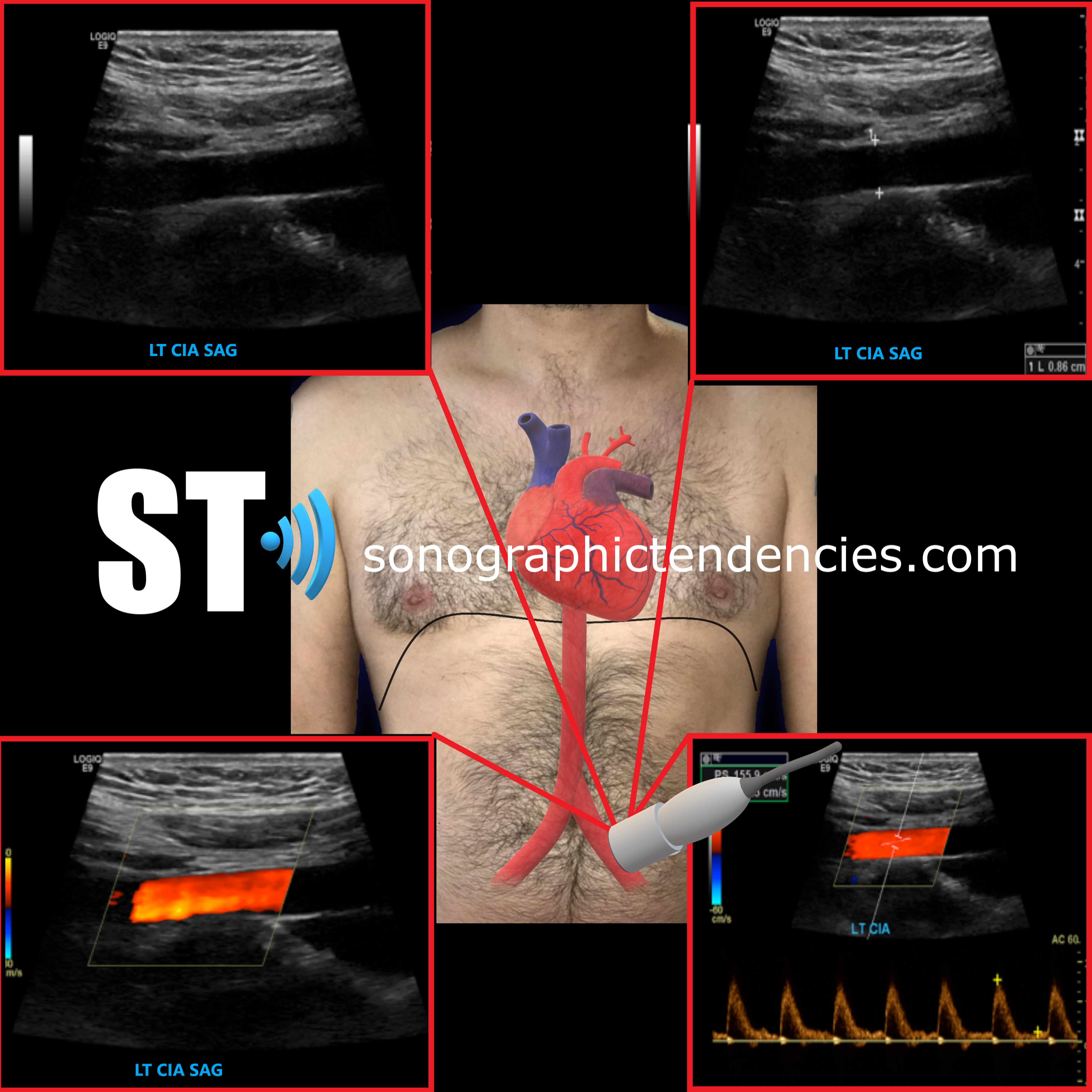 Aorta Duplex/Doppler Protocol – Sonographic Tendencies