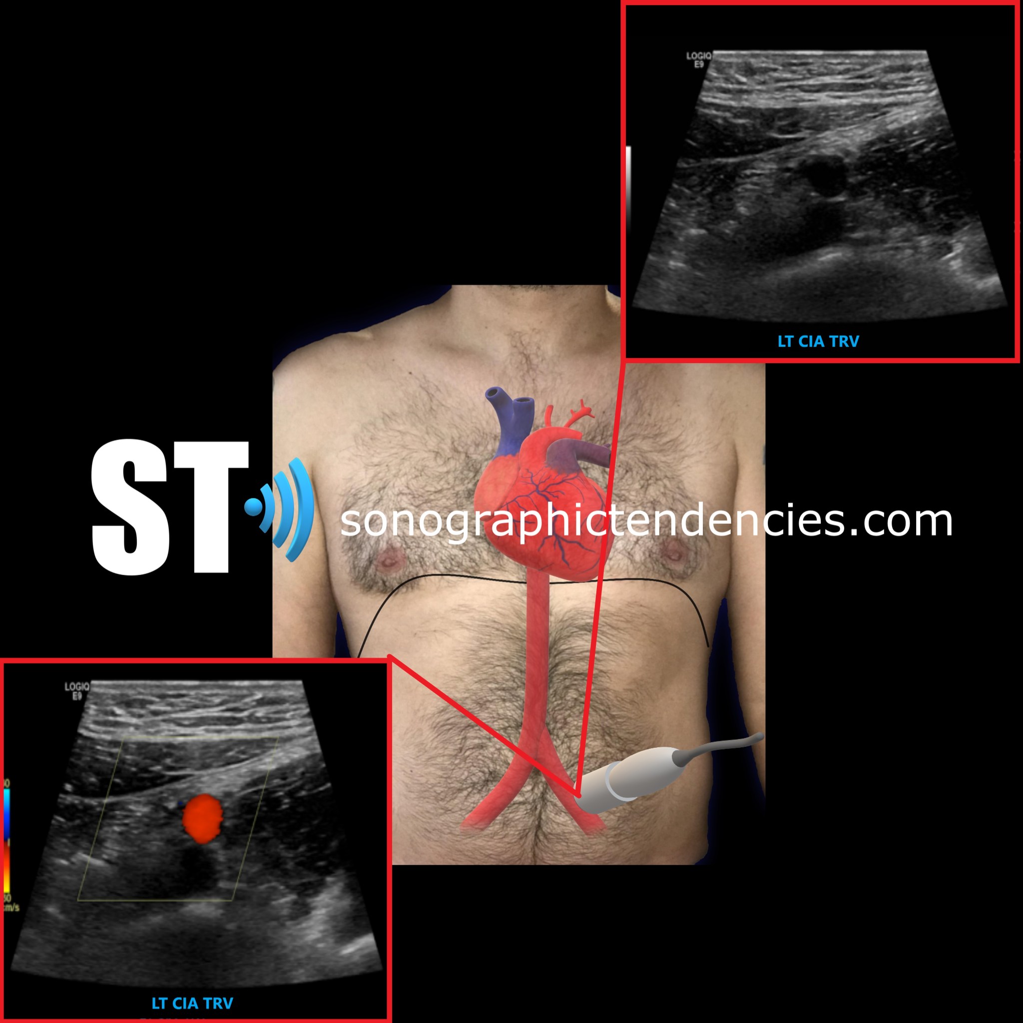Aorta Duplex/Doppler Protocol – Sonographic Tendencies