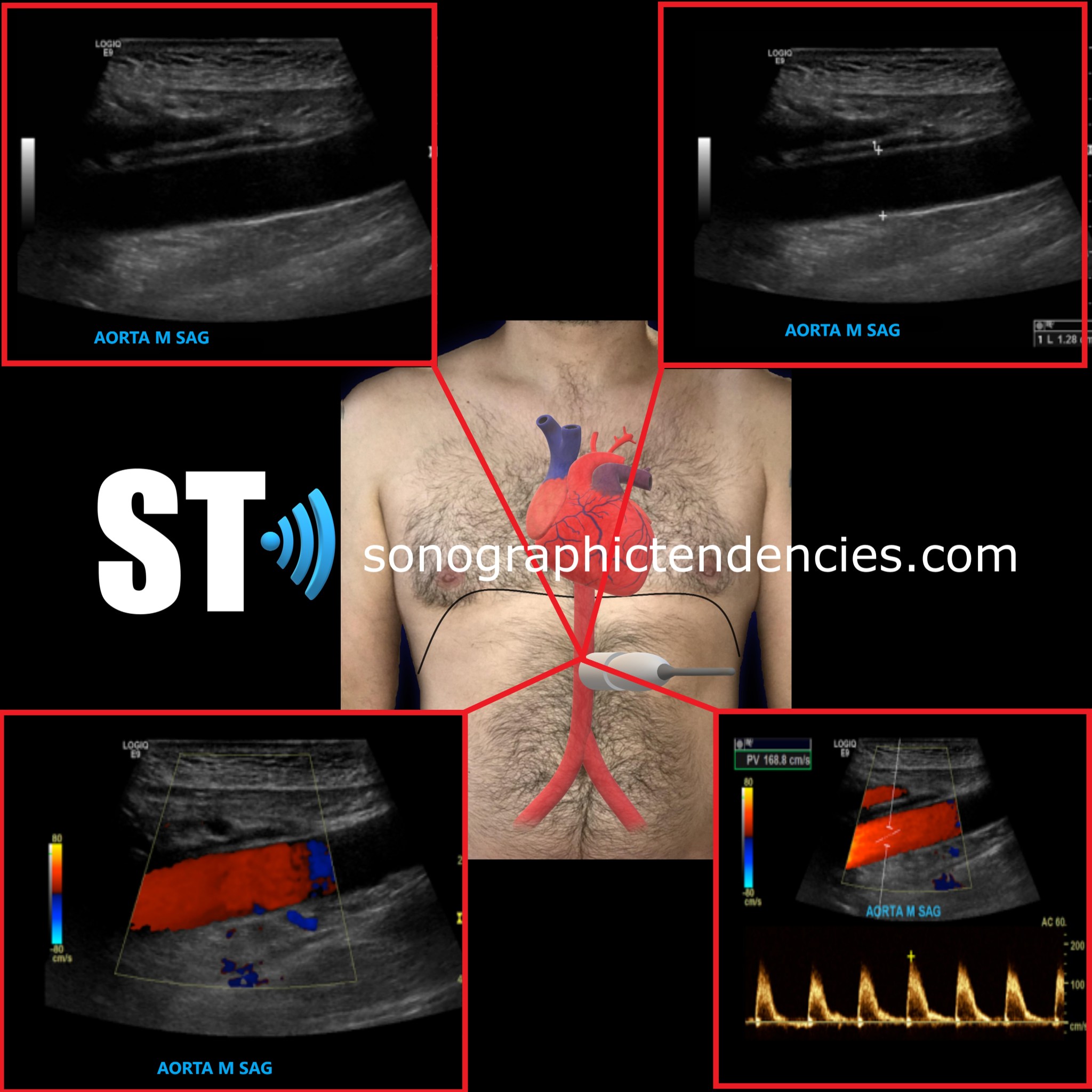 Aorta Duplex/Doppler Protocol – Sonographic Tendencies