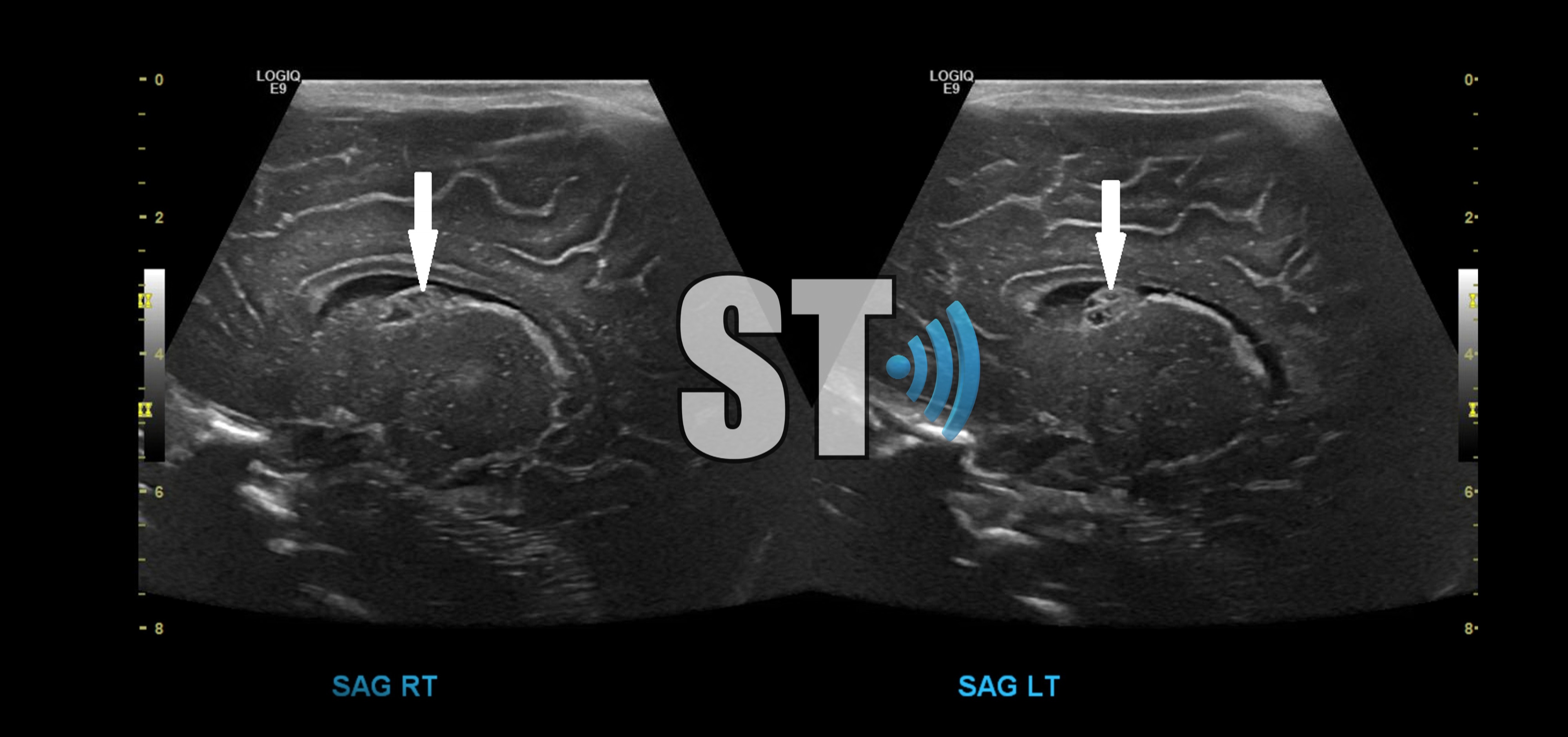 Intraventricular Hemorrhage – Sonographic Tendencies
