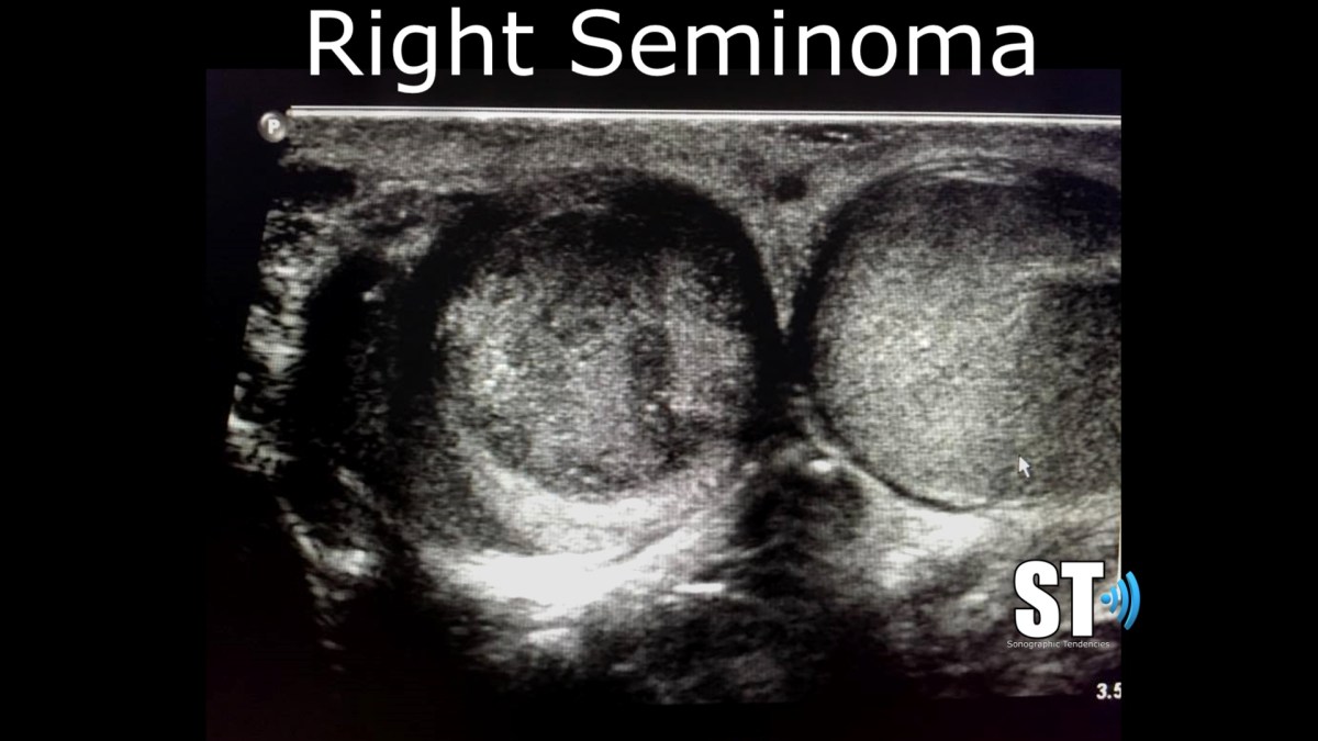 Testicular/Scrotal Doppler Protocol – Sonographic Tendencies