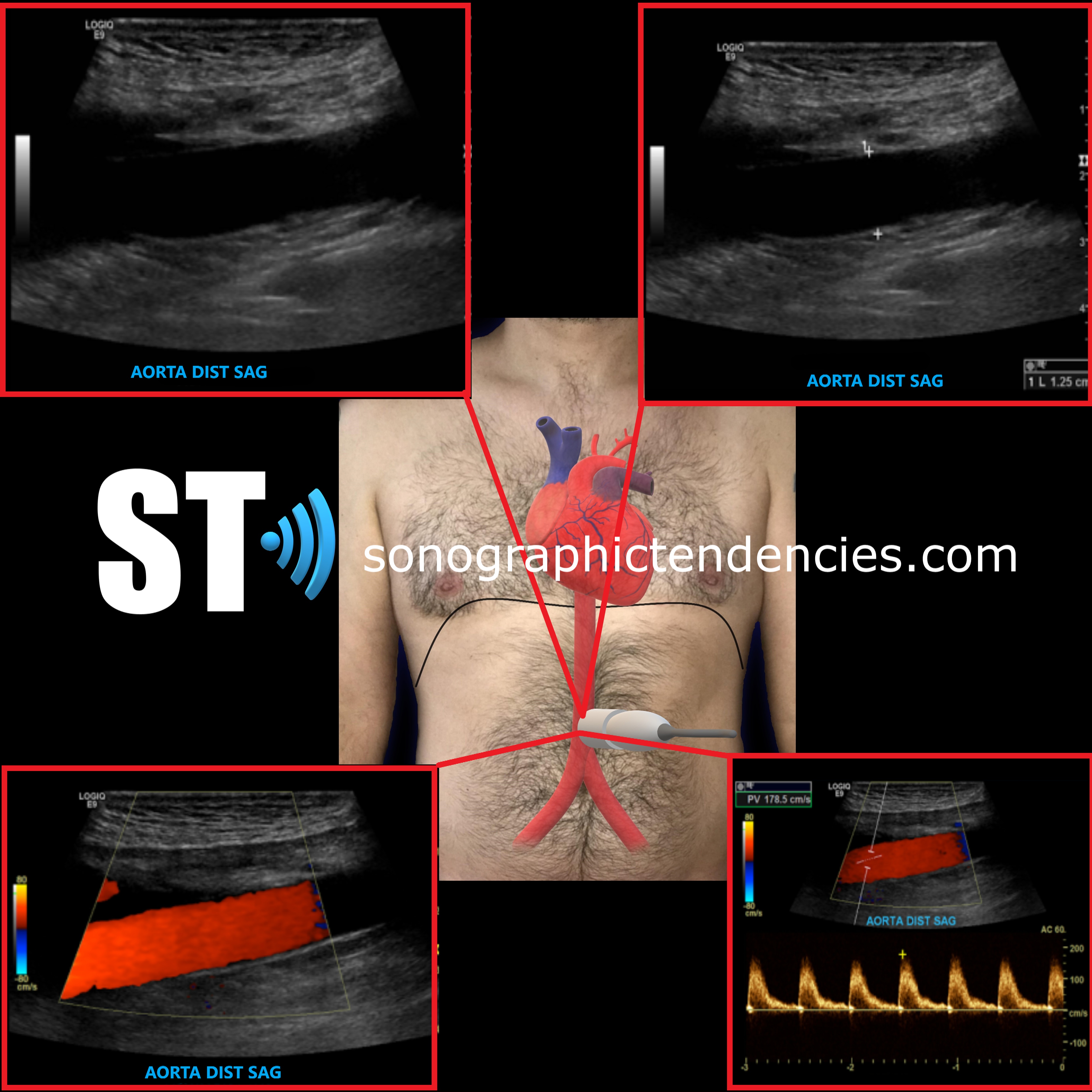 Aorta Duplex/Doppler Protocol – Sonographic Tendencies