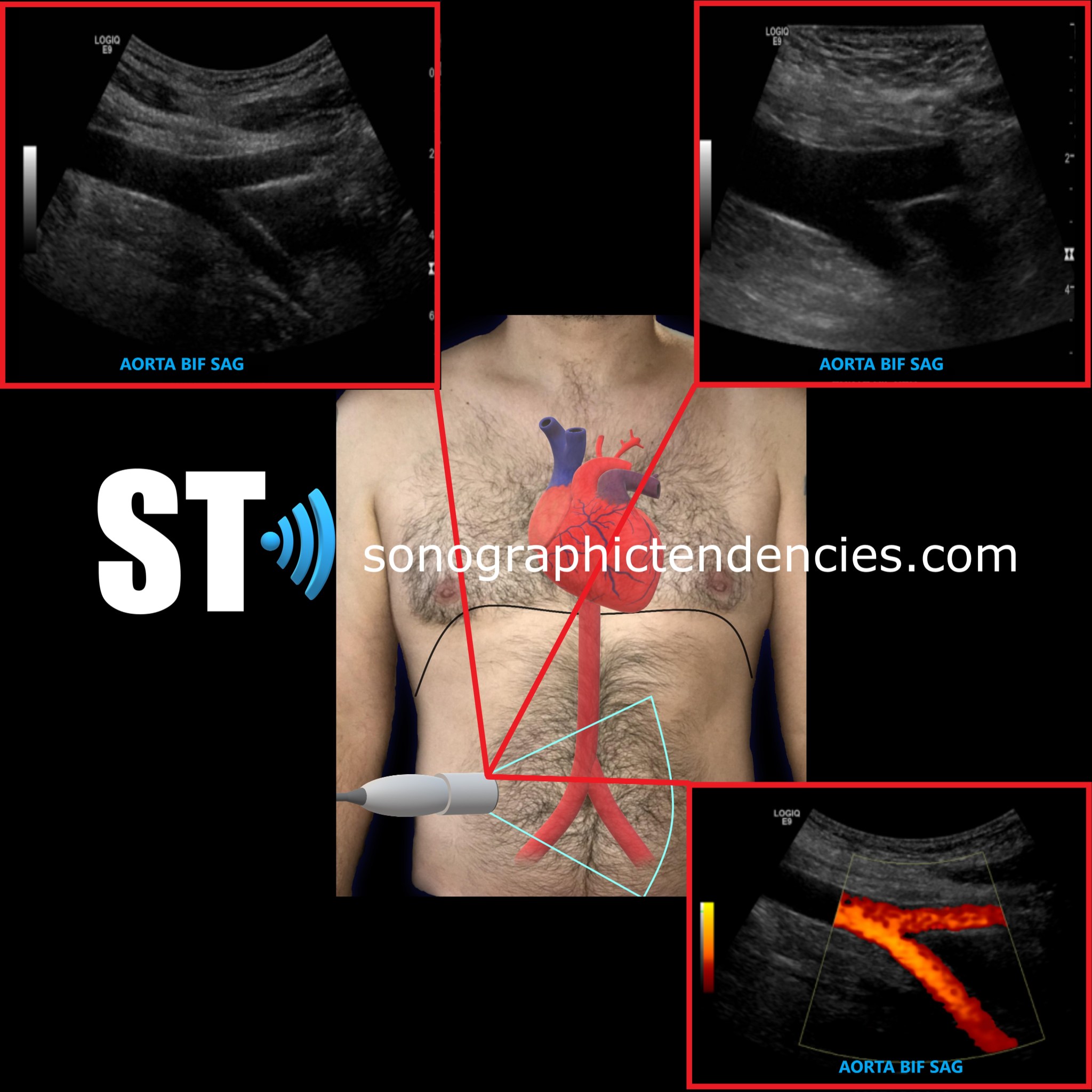Aorta Duplex/Doppler Protocol – Sonographic Tendencies