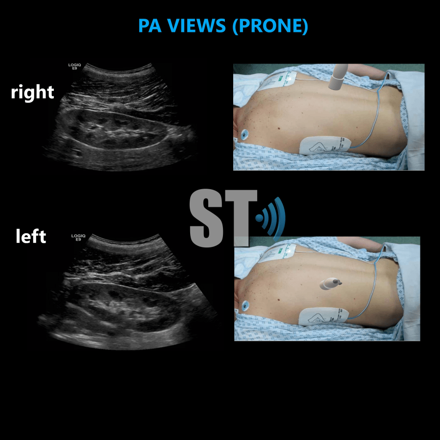 Renal Ultrasound Complete Protocol – Sonographic Tendencies