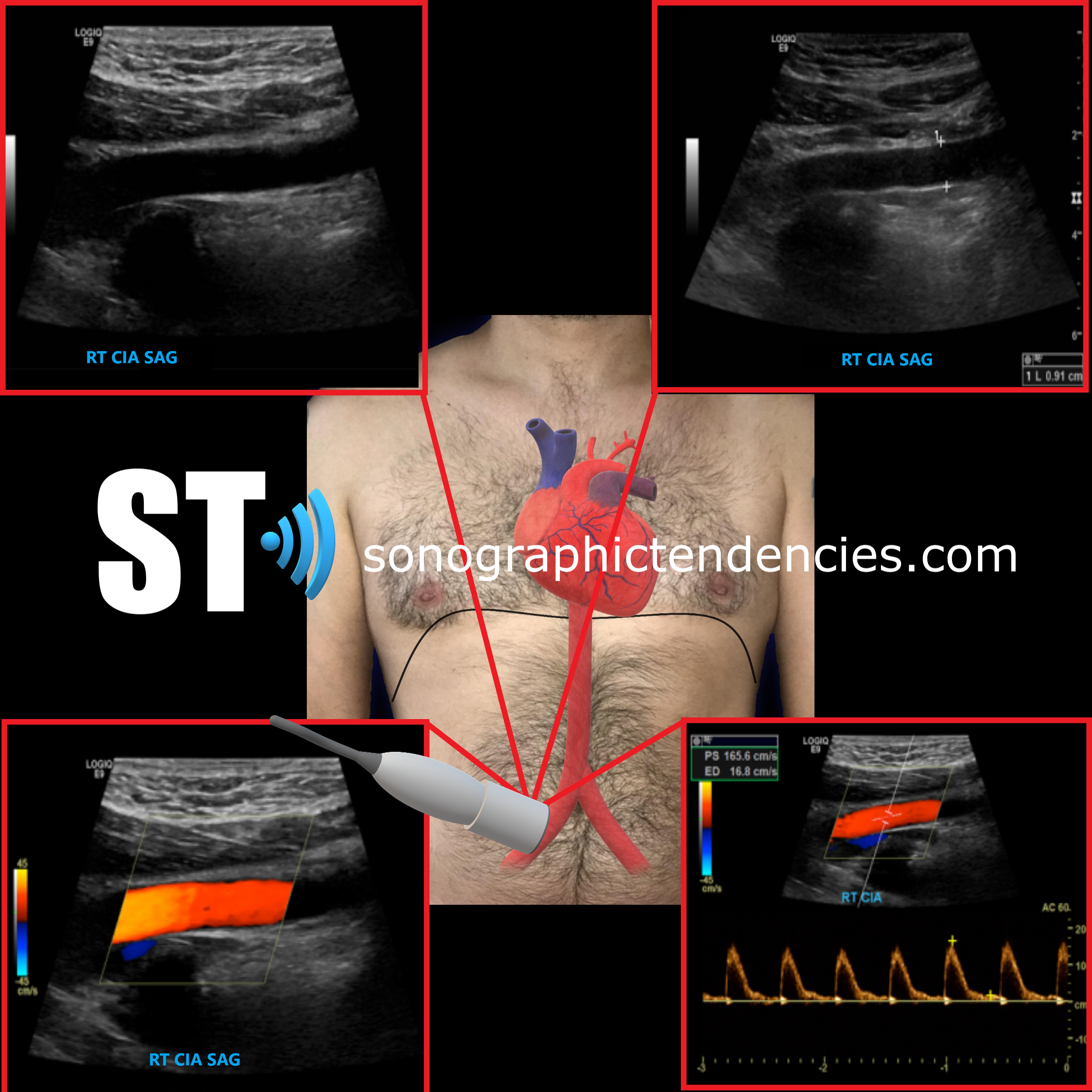 Aorta Duplex/Doppler Protocol – Sonographic Tendencies