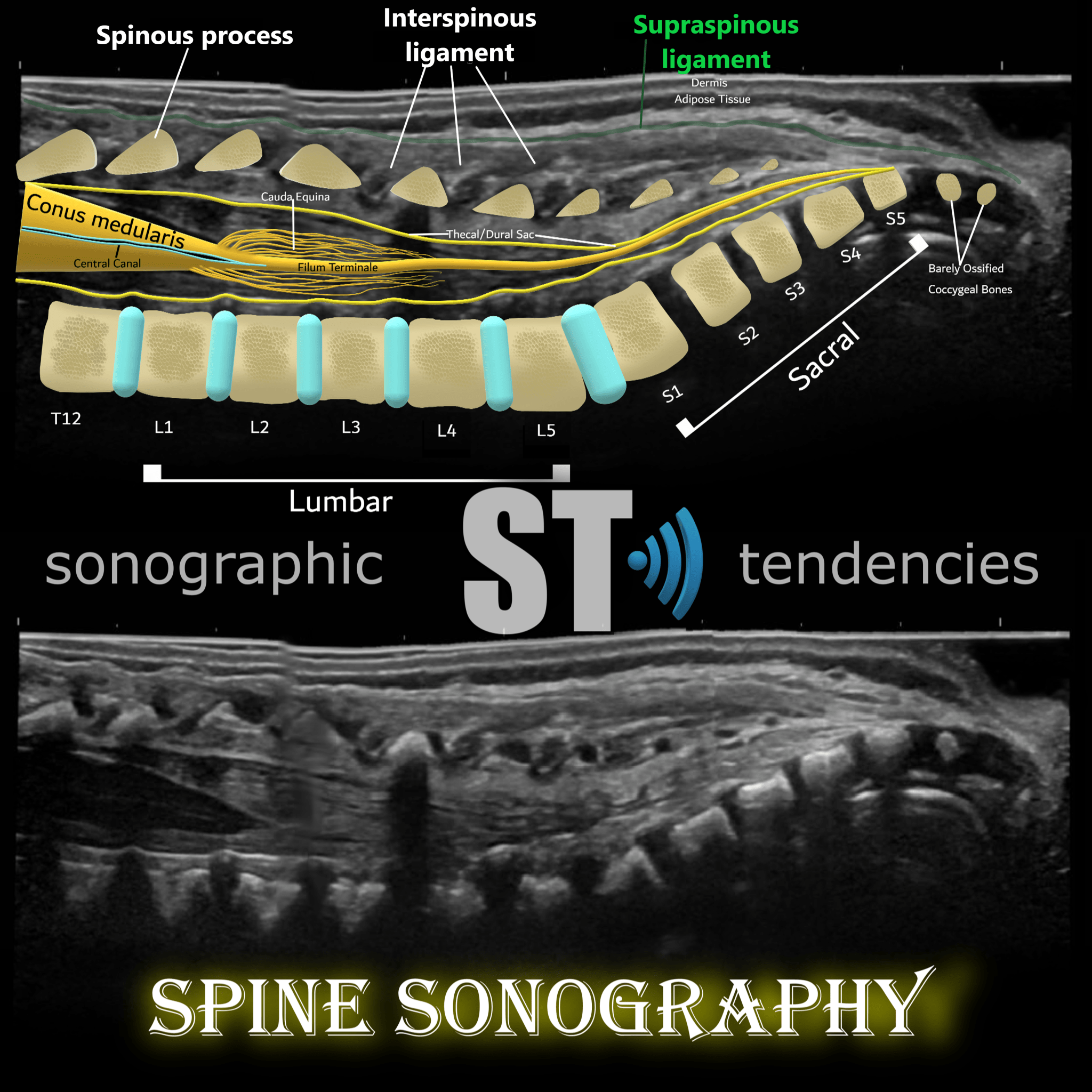 Neonatal/Infant Spine – Sonographic Tendencies