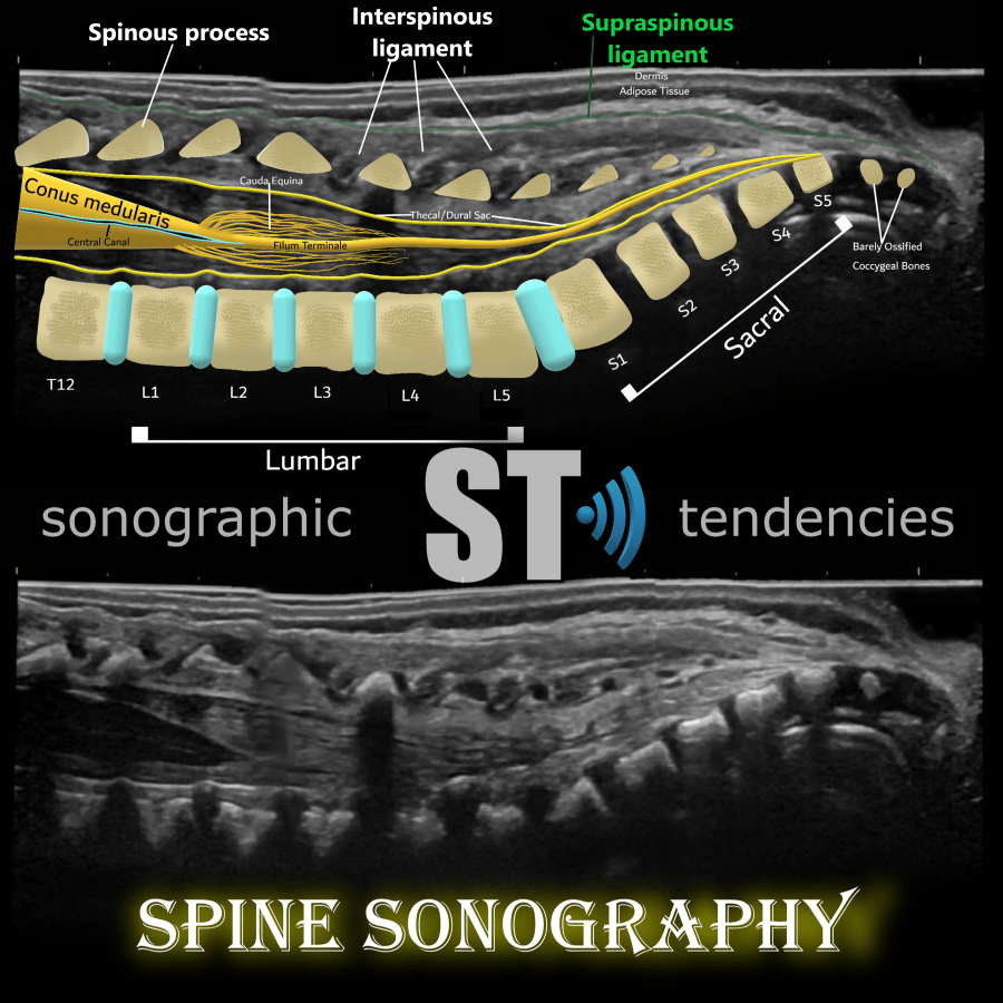 Neonatal/Infant Spine – Sonographic Tendencies