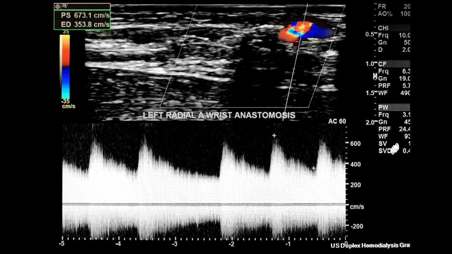 Hemodialysis Vascular Access – Sonographic Tendencies