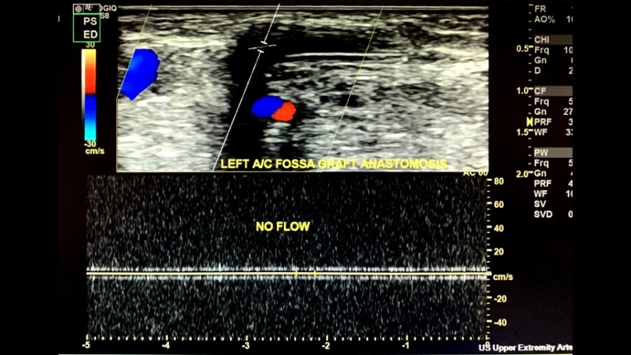 Hemodialysis Vascular Access – Sonographic Tendencies