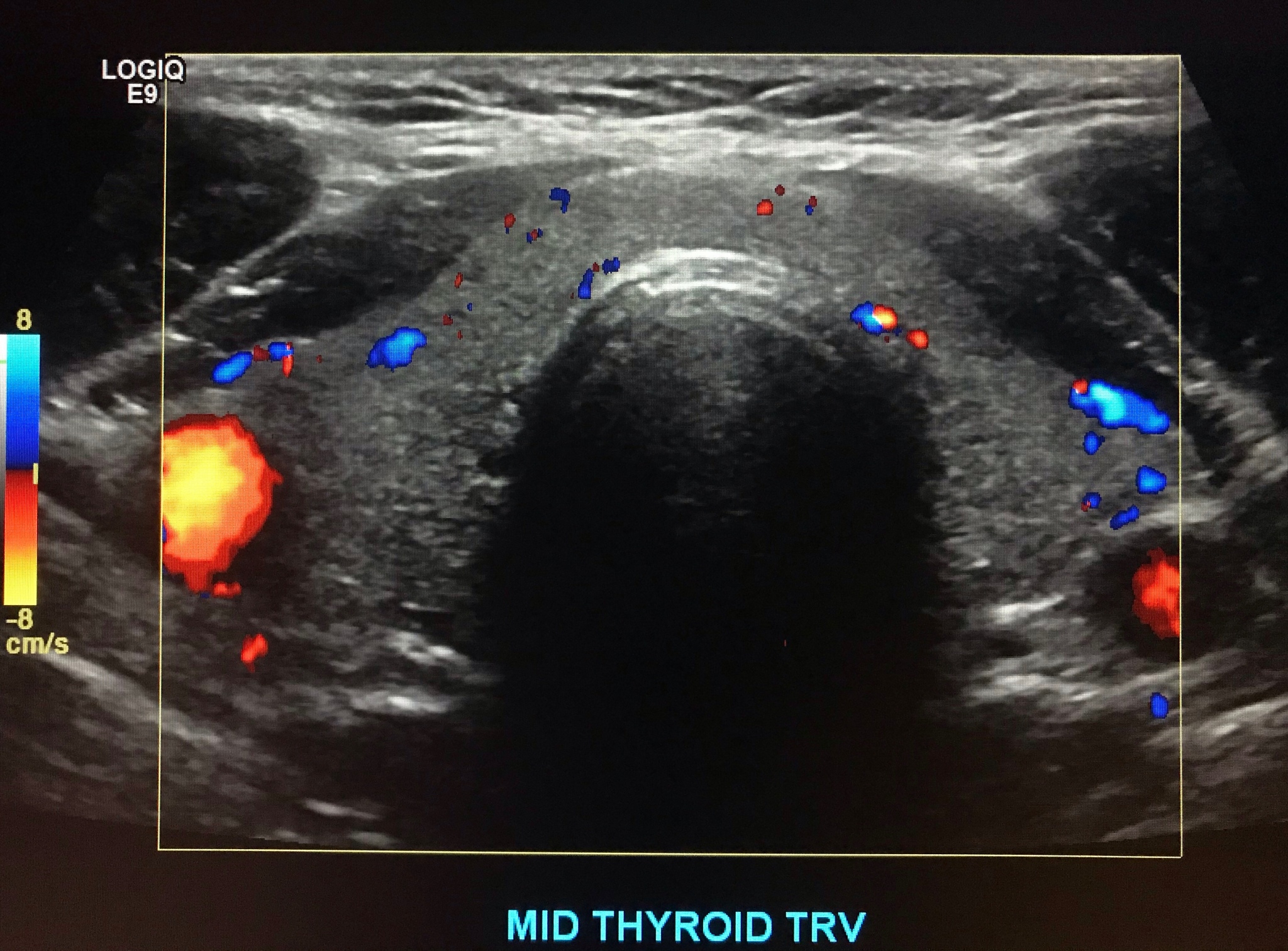 Thyroid Ultrasound Protocol – Sonographic Tendencies