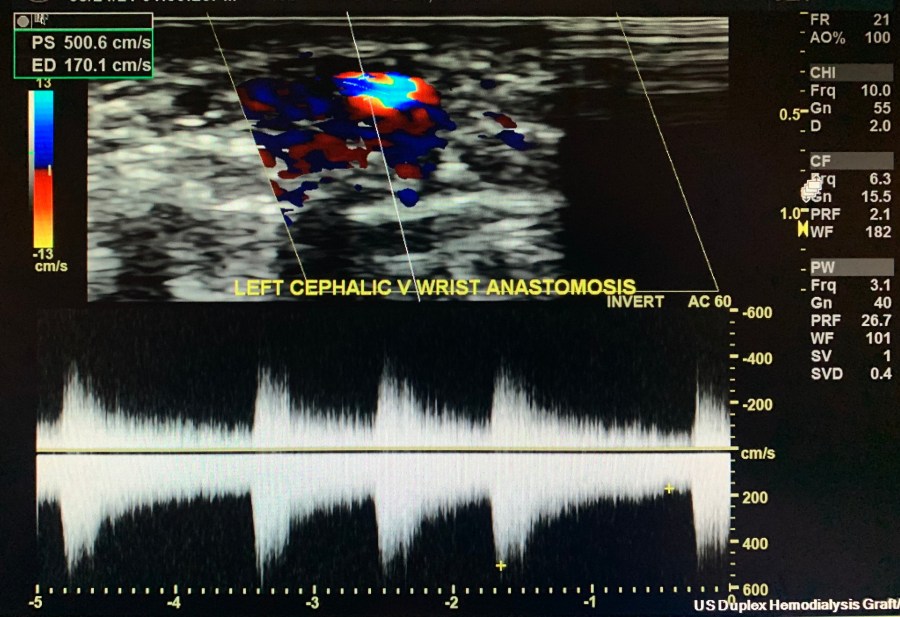 Hemodialysis Vascular Access – Sonographic Tendencies
