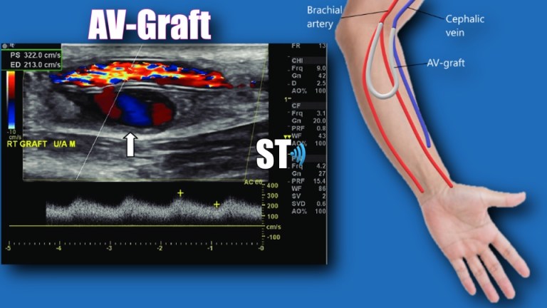 Hemodialysis Vascular Access – Sonographic Tendencies